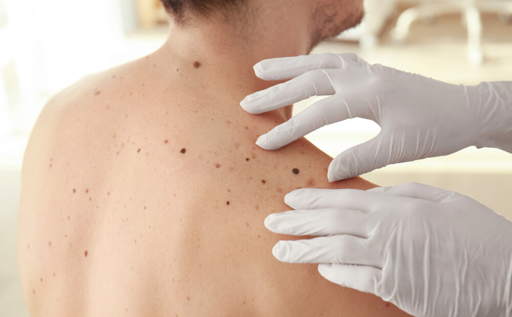 Ja līdz 25 gadu vecumam ir bijis saules apdegums, tad nākotnē ir liela ...