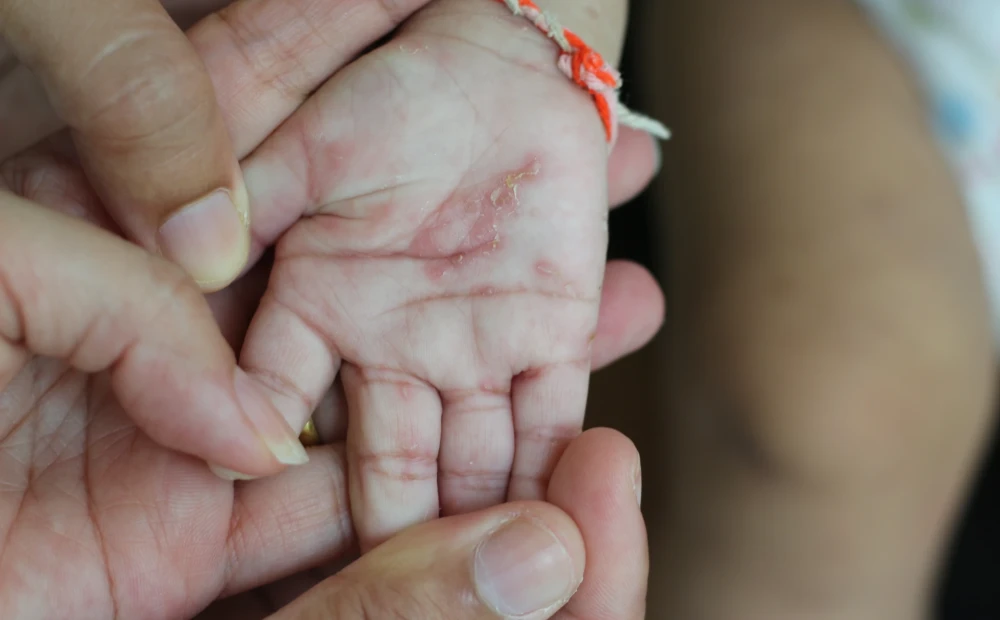 Utis, kašķis, spalīši - kādi signāli liecina, ka uzradušies "apakšīrnieki"?