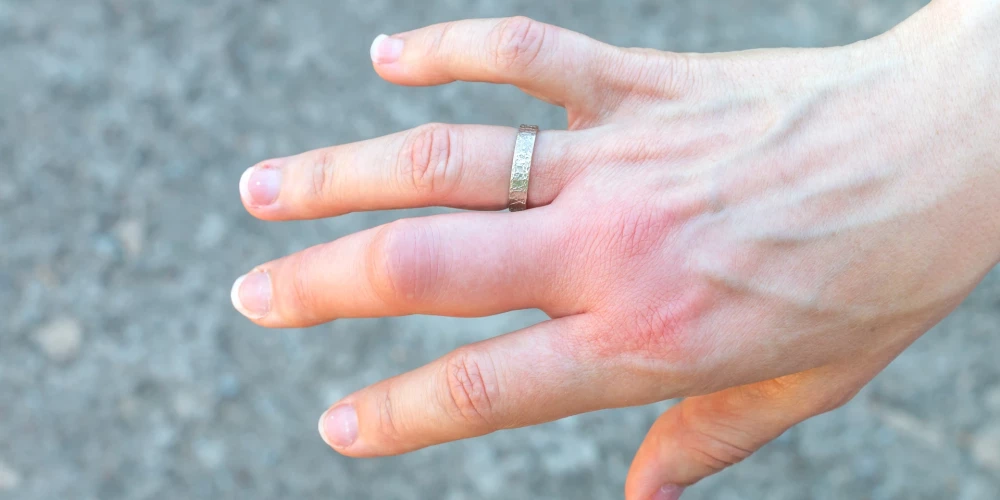 Dzelonis jāizņem obligāti! Kas ir pirmais, ko darīt, ja sadzeļ bite ...